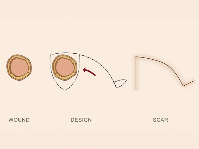 Wound closure techniques